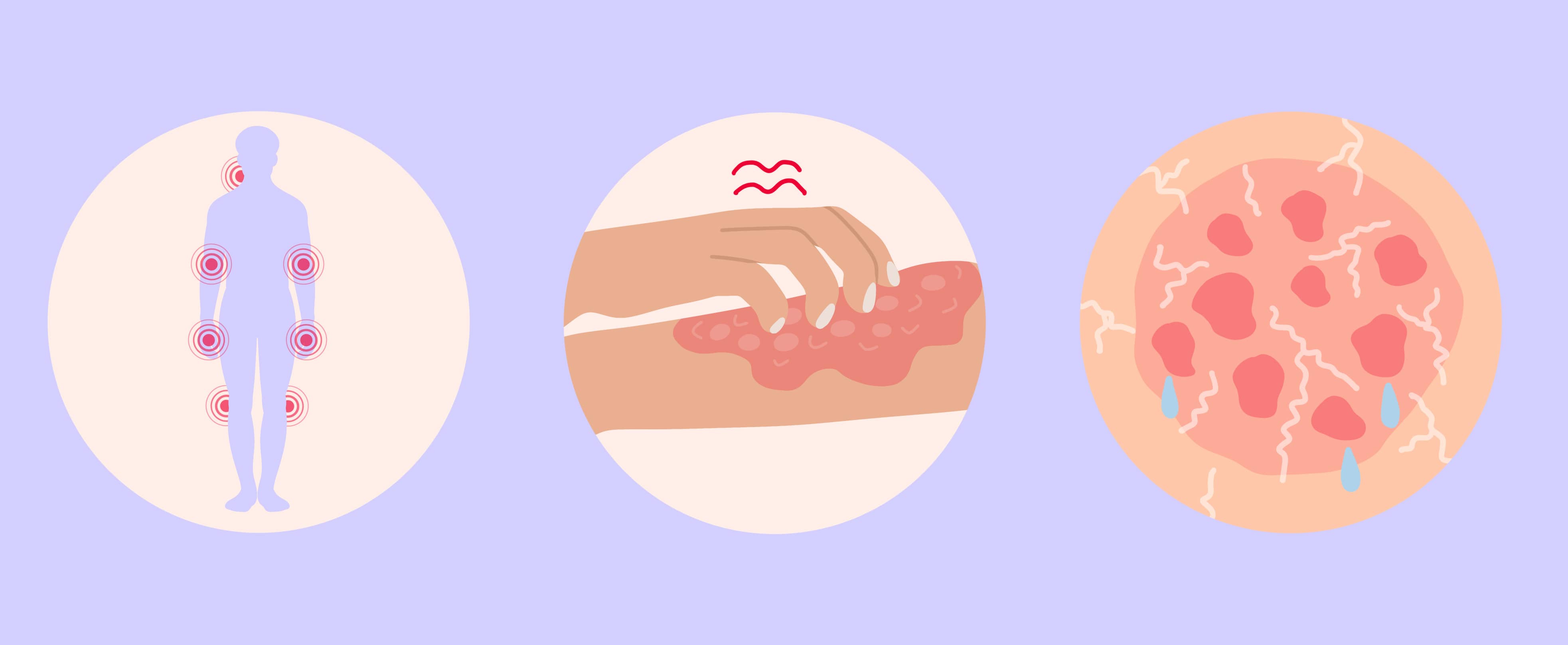 Dermatite atopique : causes et traitements | Redcare Apotheke