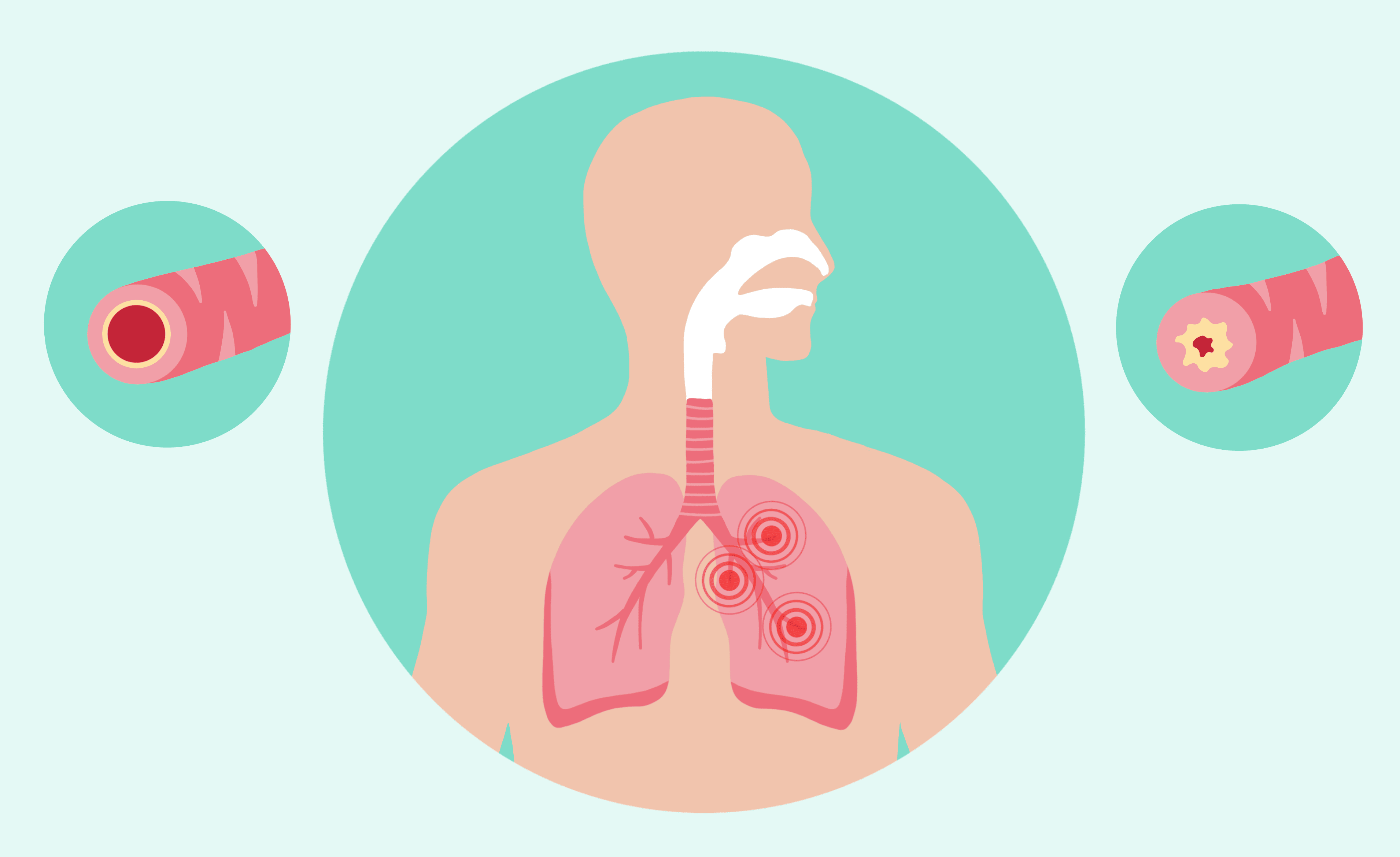 Bronchitis: advies van onze apotheker | Farmaline